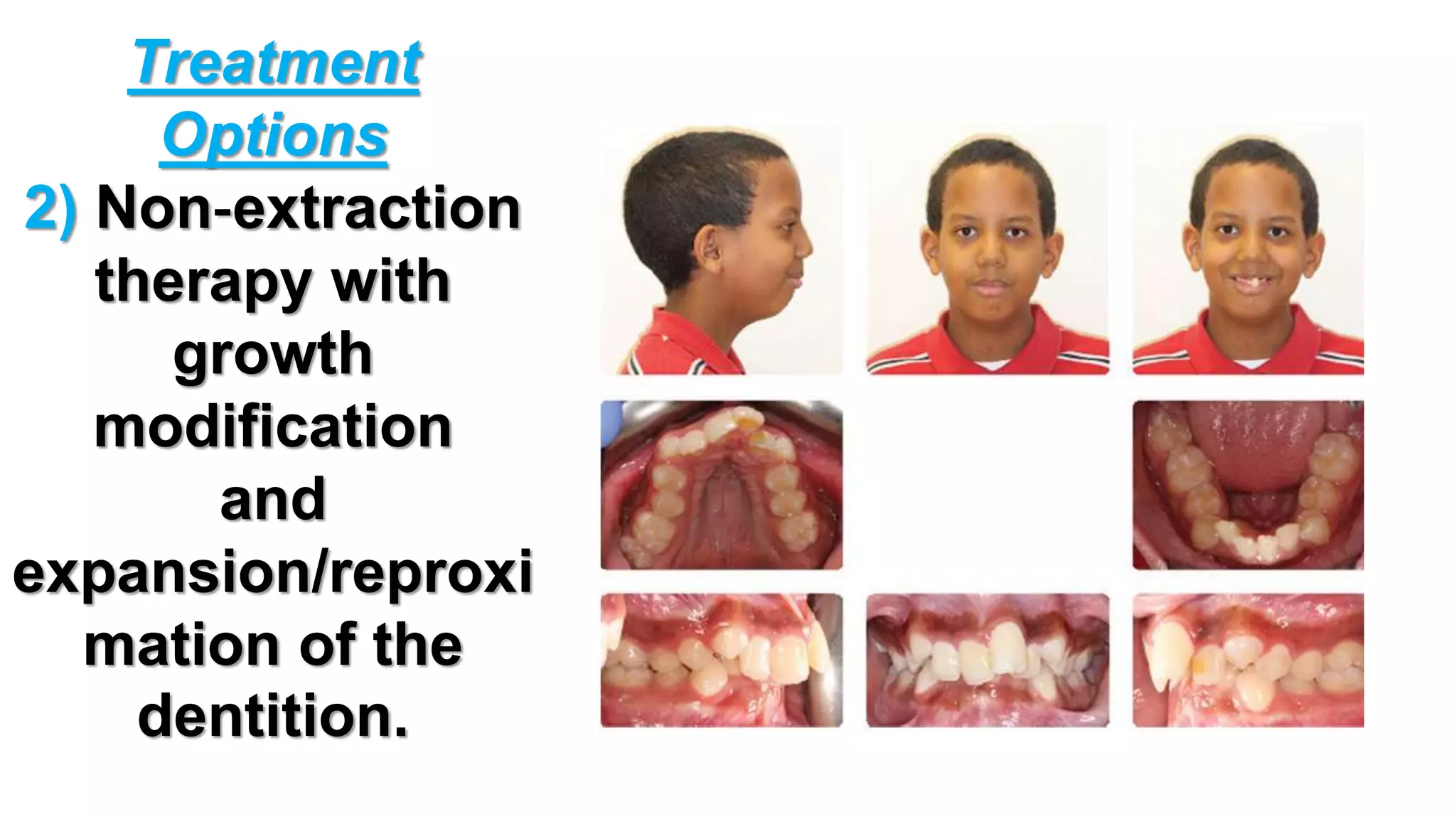 orthodontic correction of class II div 1 extraction of 4 bicuspids | PPTX
