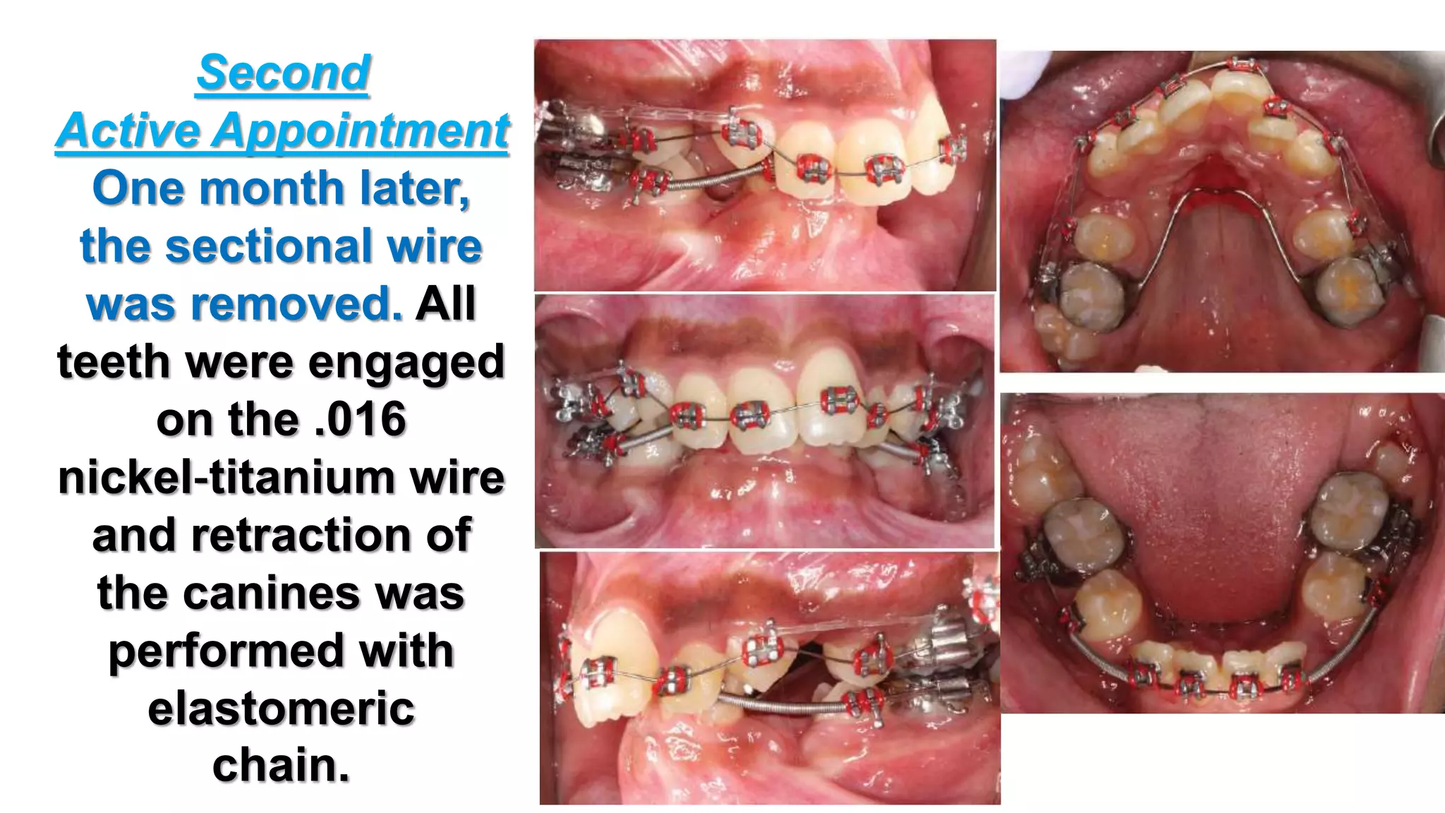 orthodontic correction of class II div 1 extraction of 4 bicuspids | PPTX