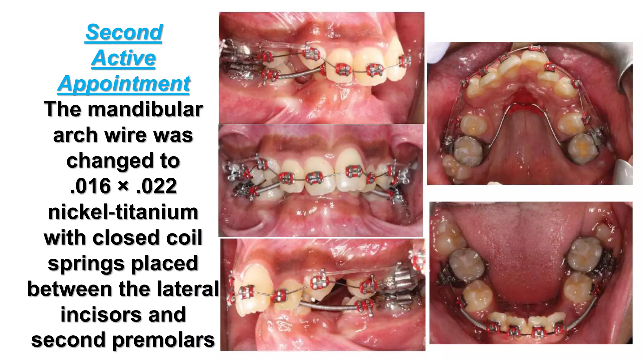 orthodontic correction of class II div 1 extraction of 4 bicuspids | PPTX