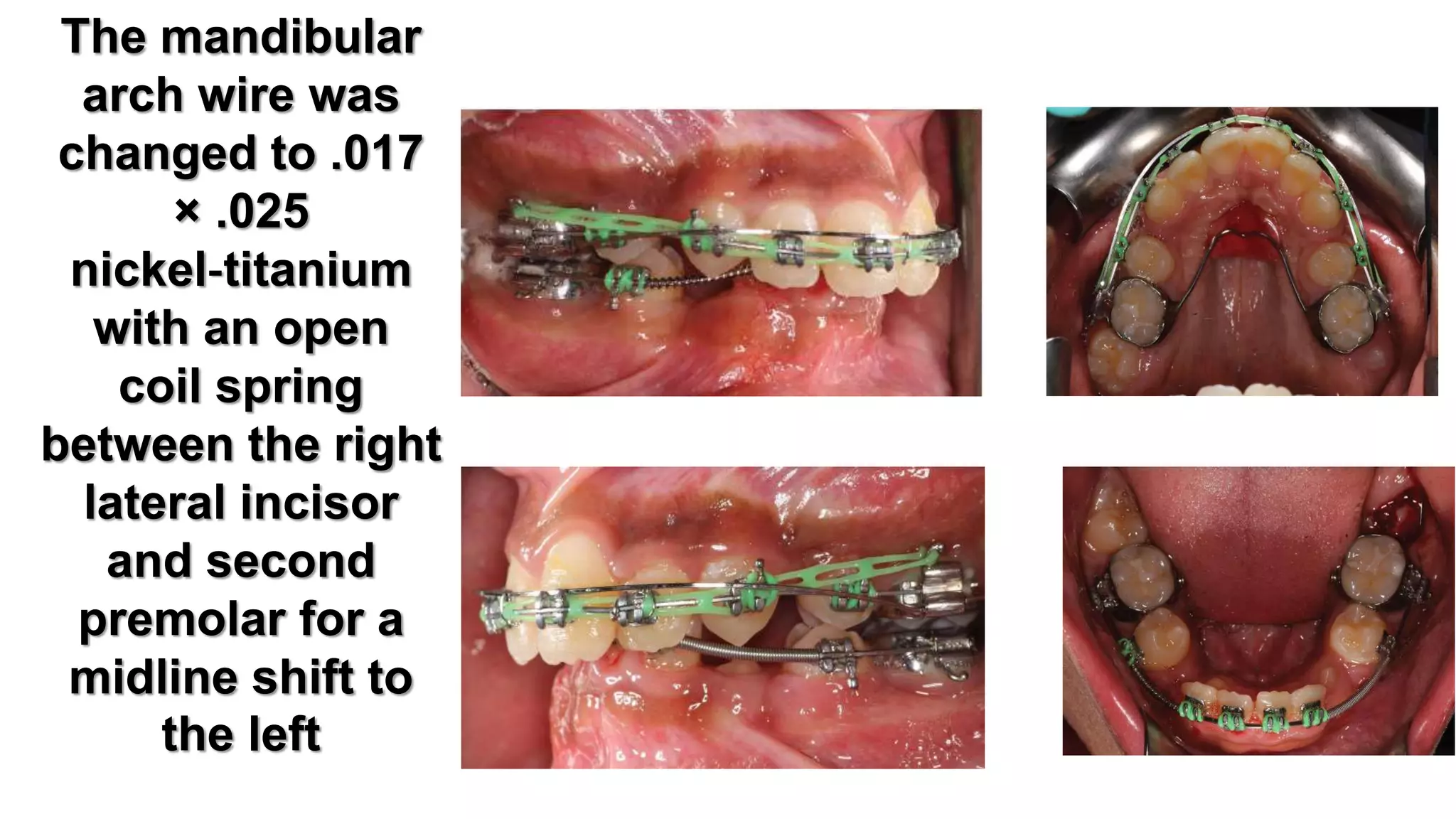 orthodontic correction of class II div 1 extraction of 4 bicuspids | PPTX