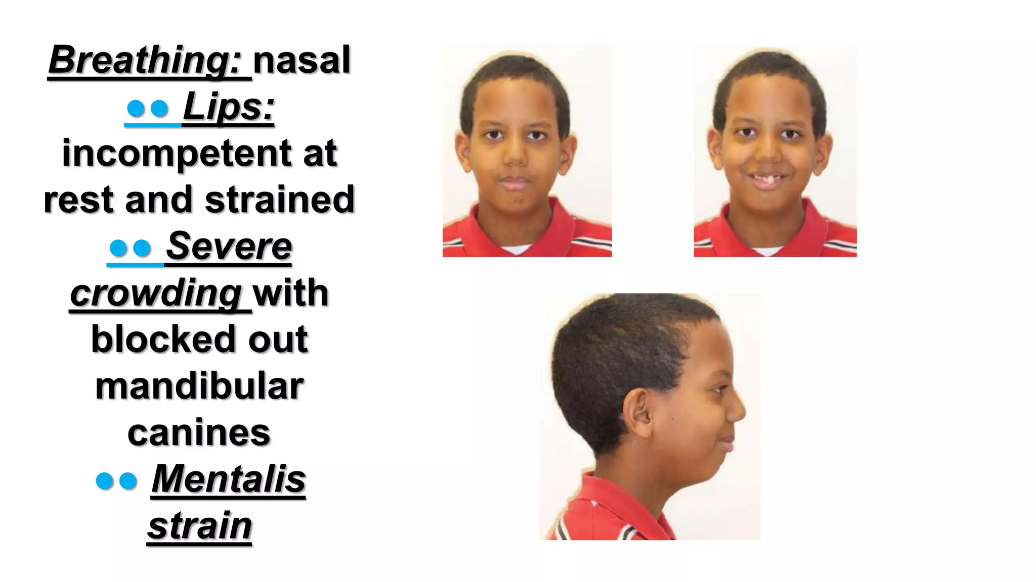 orthodontic correction of class II div 1 extraction of 4 bicuspids | PPTX