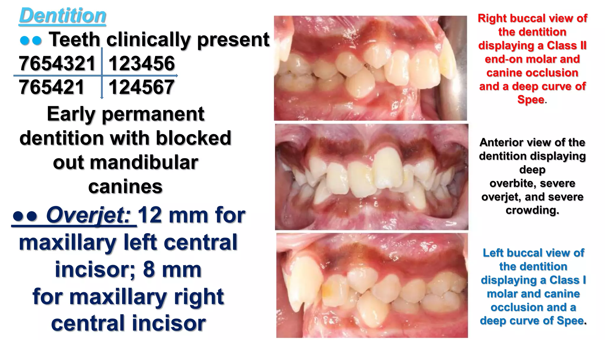 orthodontic correction of class II div 1 extraction of 4 bicuspids | PPTX