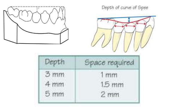 orthodontic correction of class II div 1 extraction of 4 bicuspids | PPTX