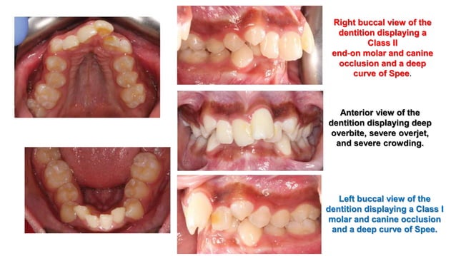orthodontic correction of class II div 1 extraction of 4 bicuspids | PPTX