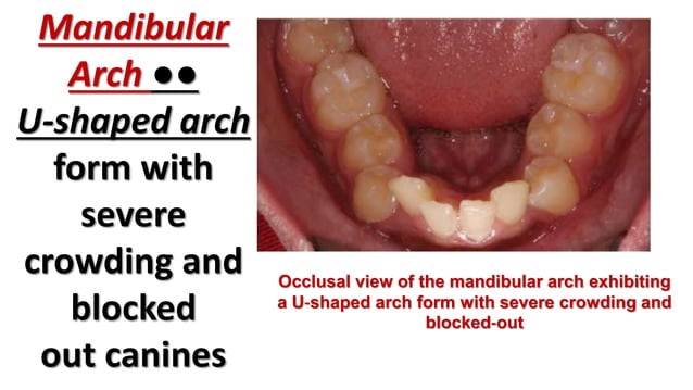orthodontic correction of class II div 1 extraction of 4 bicuspids | PPTX