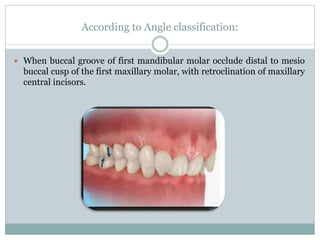 Class ii div 2 | PPTX