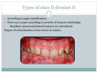 Class ii div 2 | PPTX