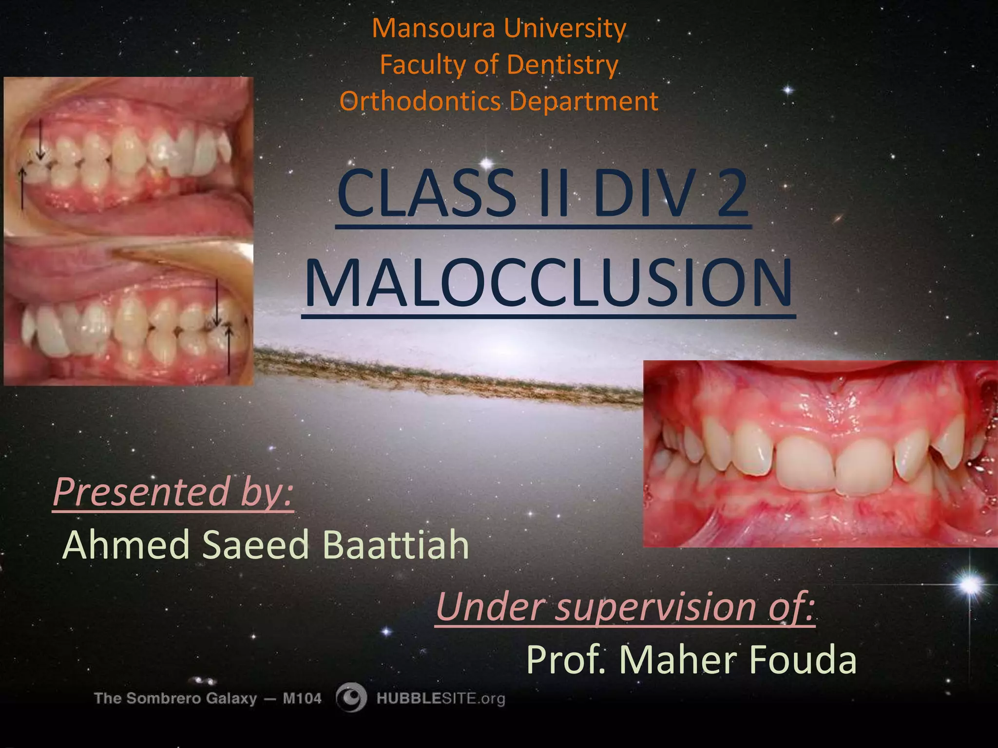 Class ii div 2 malocclusion | PPTX