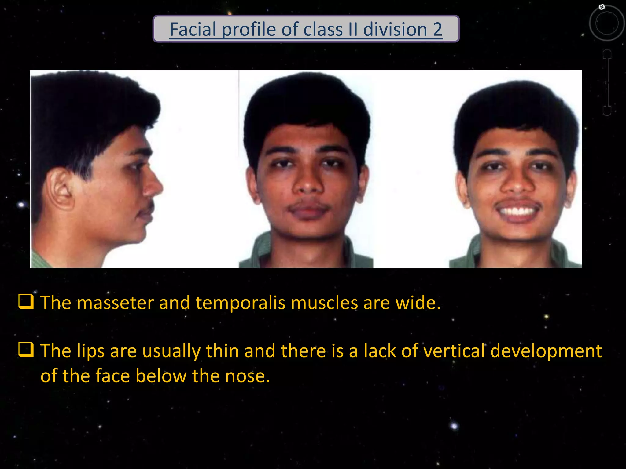 Class ii div 2 malocclusion | PPTX