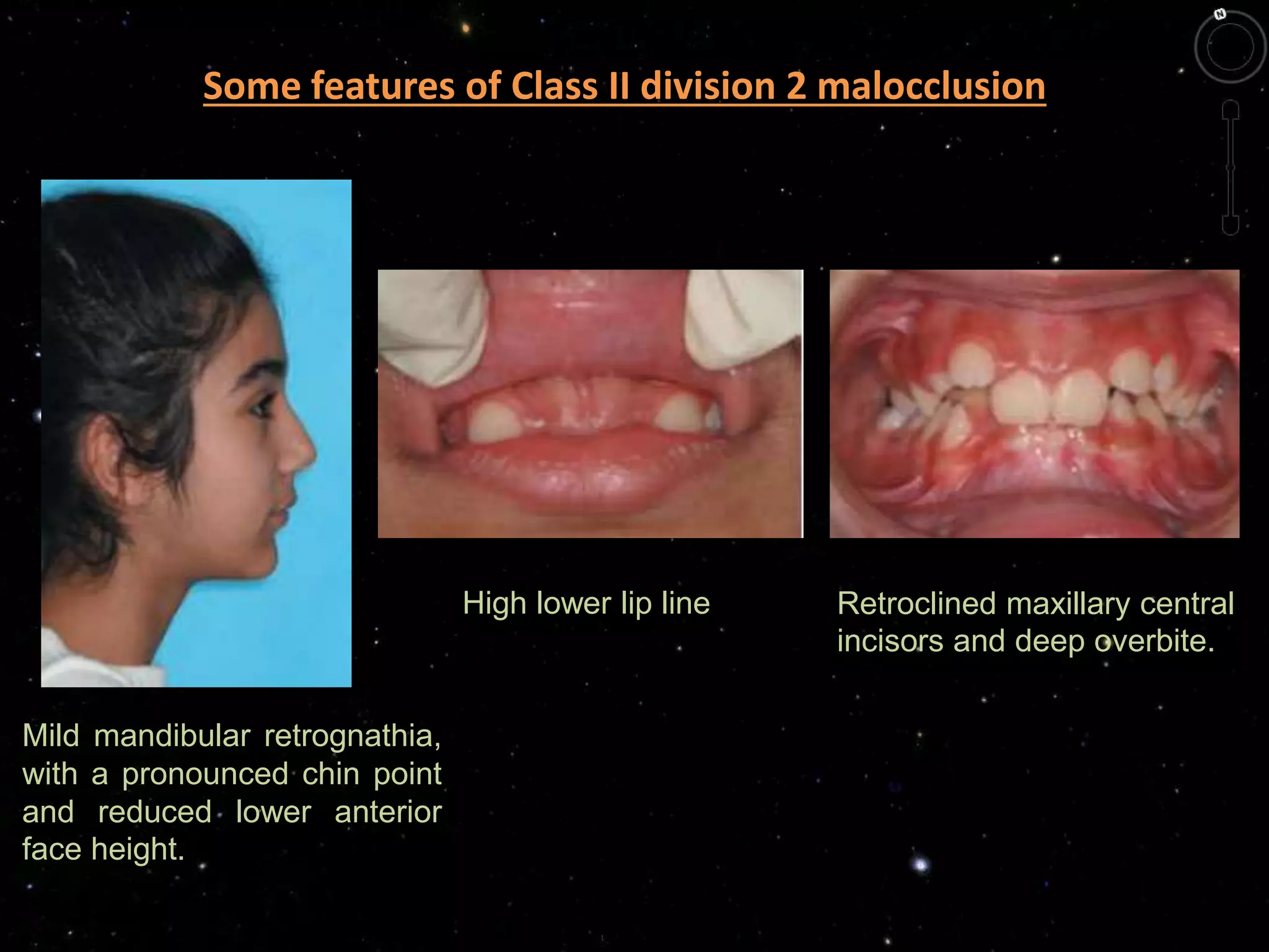 Class ii div 2 malocclusion | PPTX