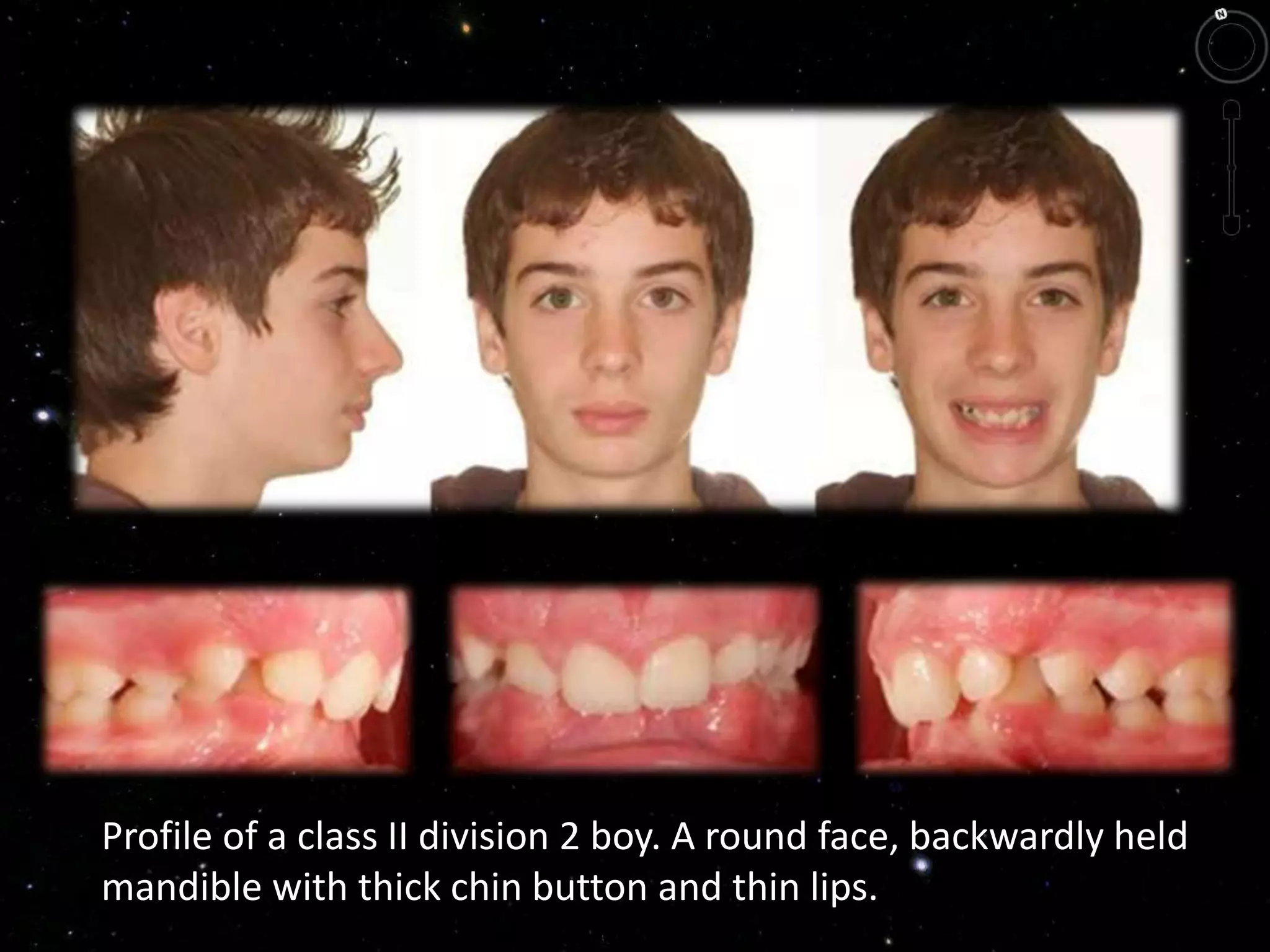 Class ii div 2 malocclusion | PPTX