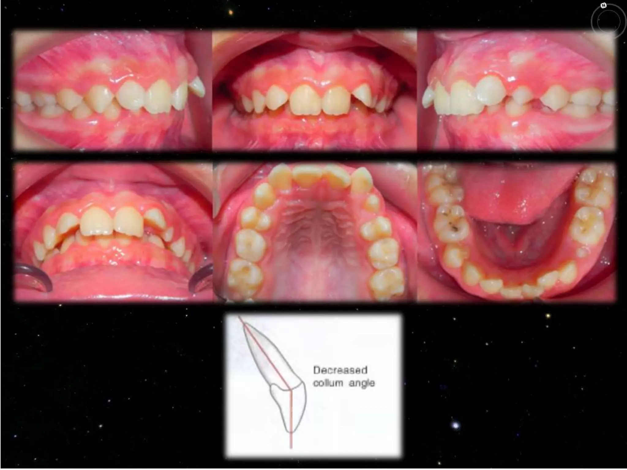 Class ii div 2 malocclusion | PPTX
