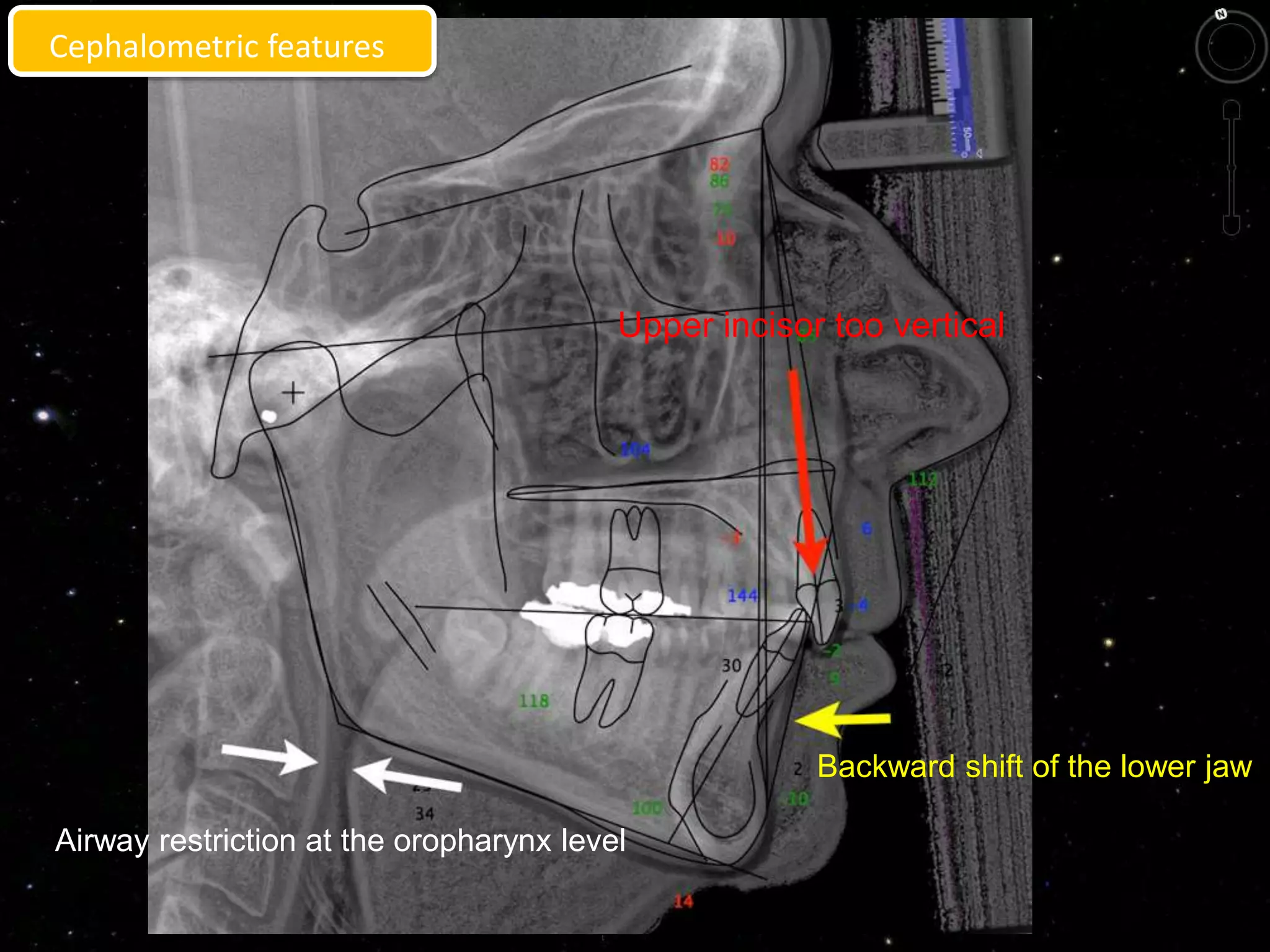 Class ii div 2 malocclusion | PPTX