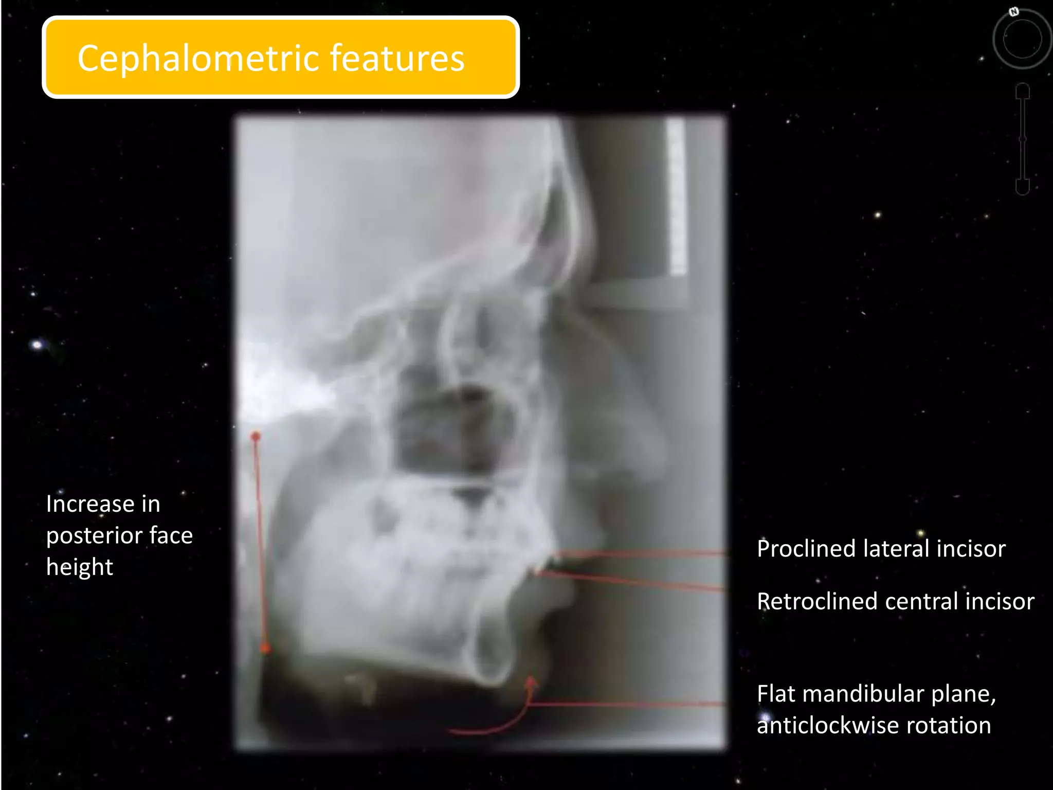 Class ii div 2 malocclusion | PPTX