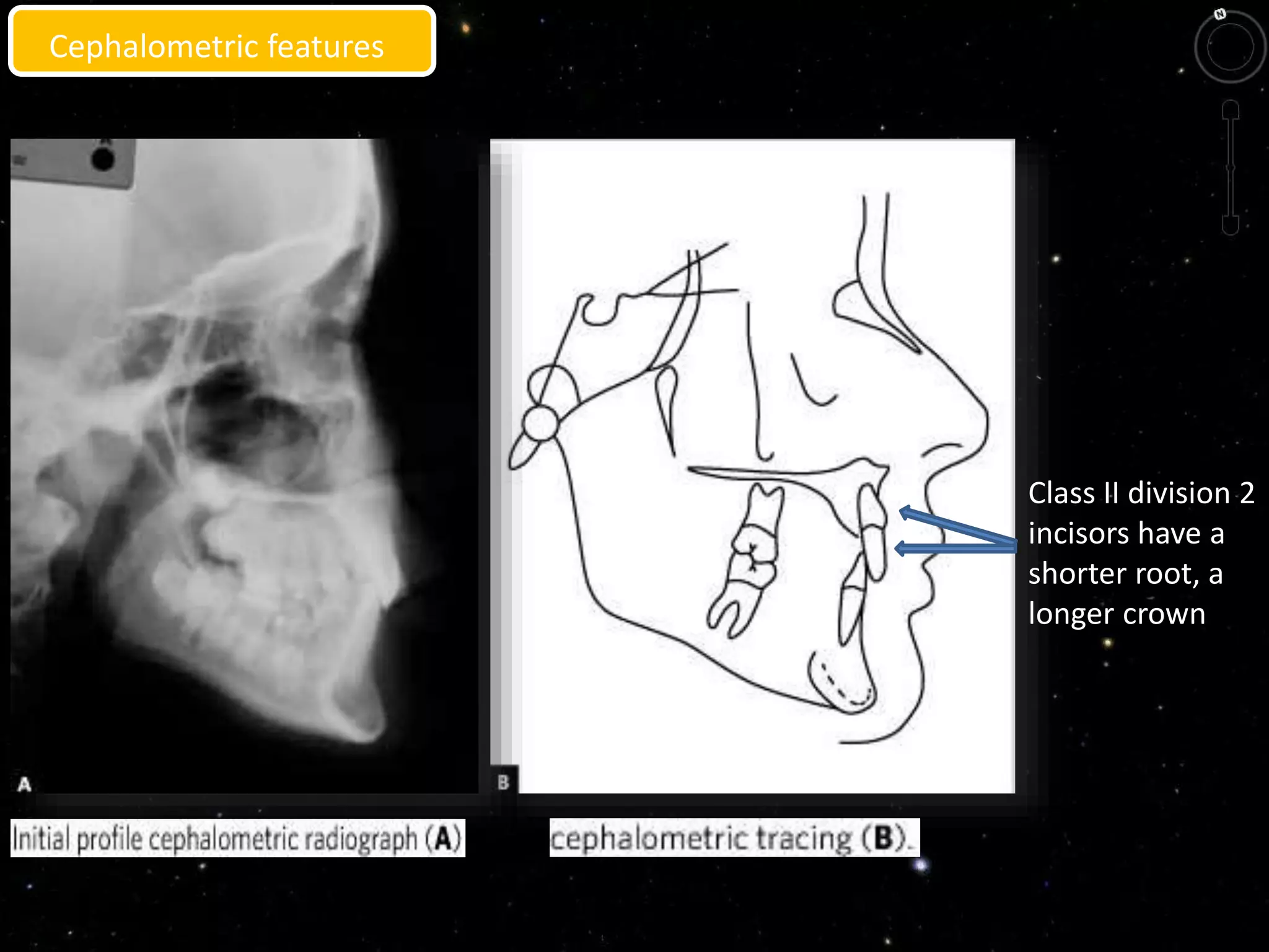 Class ii div 2 malocclusion | PPTX
