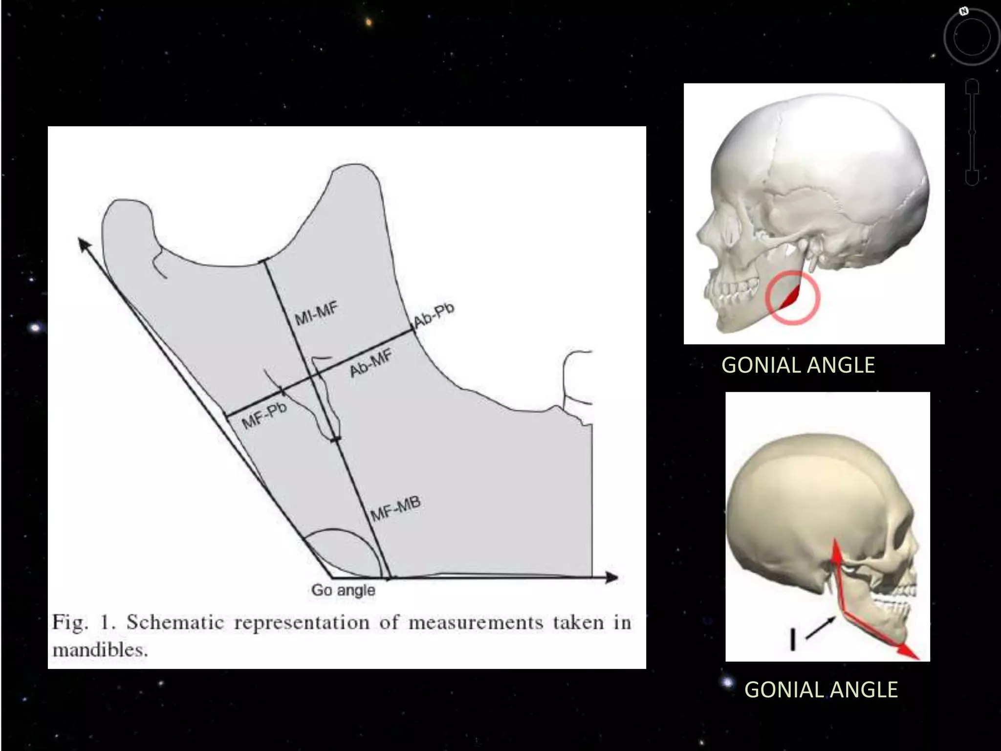 Class ii div 2 malocclusion | PPTX