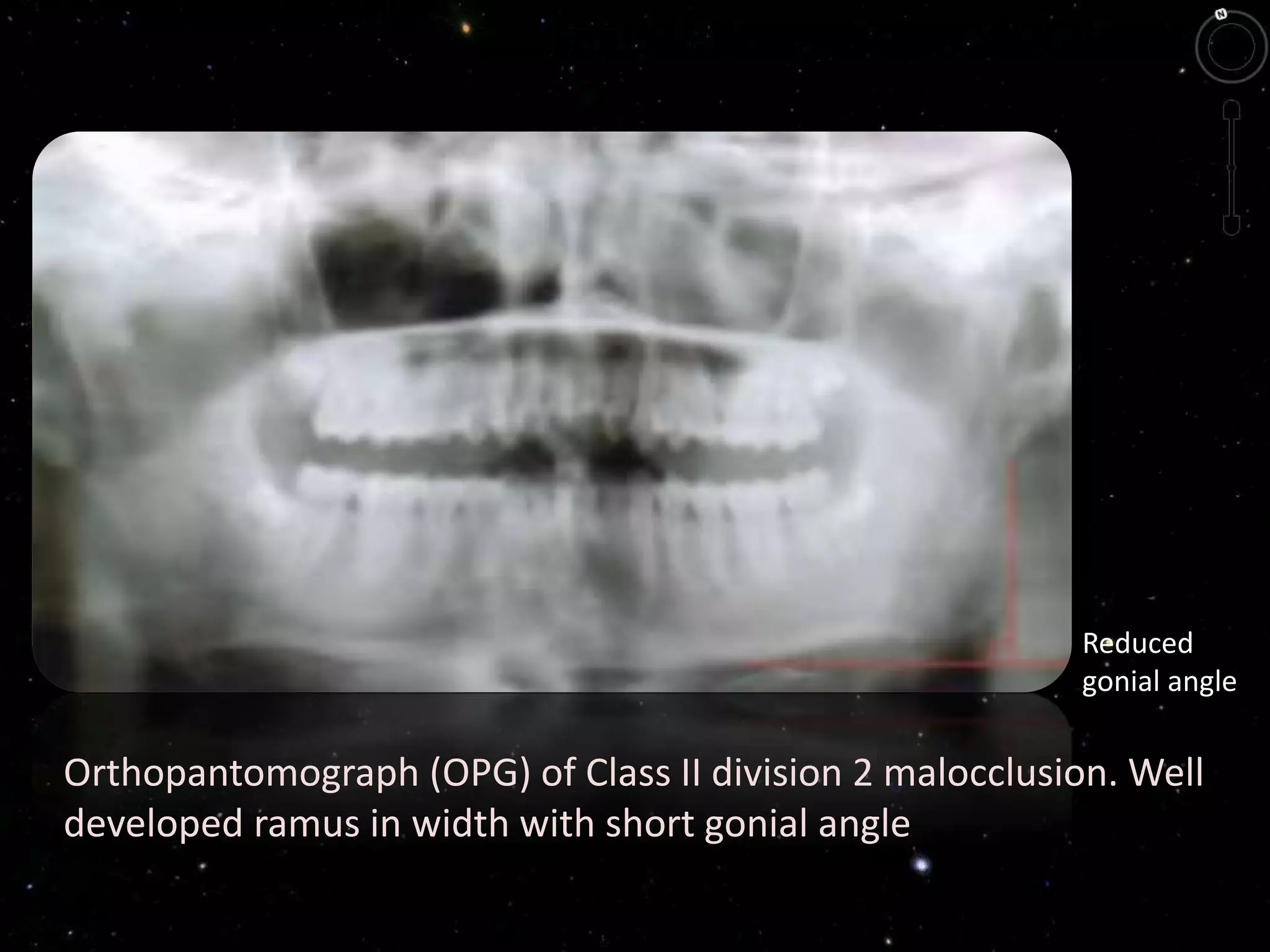 Class ii div 2 malocclusion | PPTX