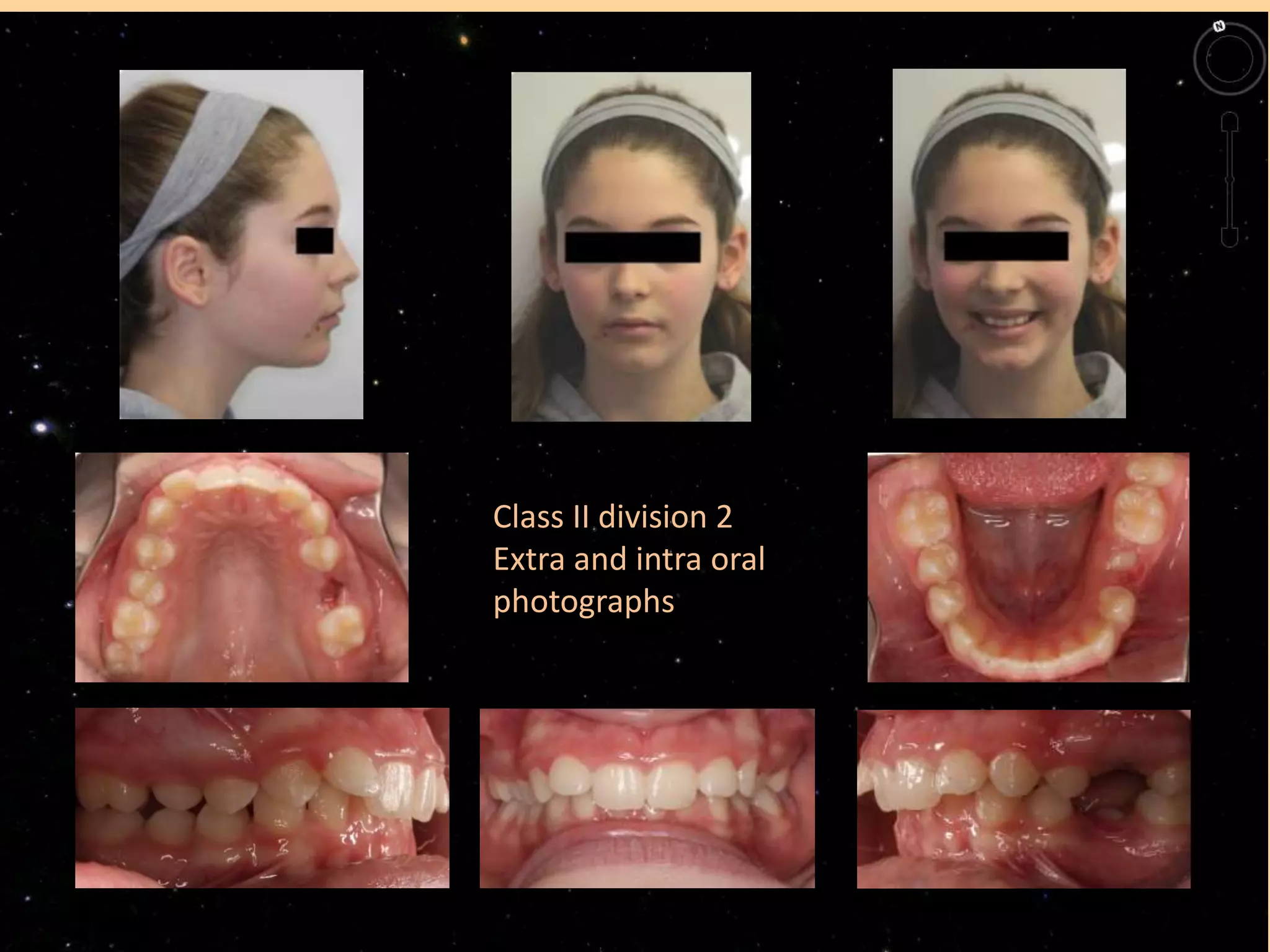 Class ii div 2 malocclusion | PPTX