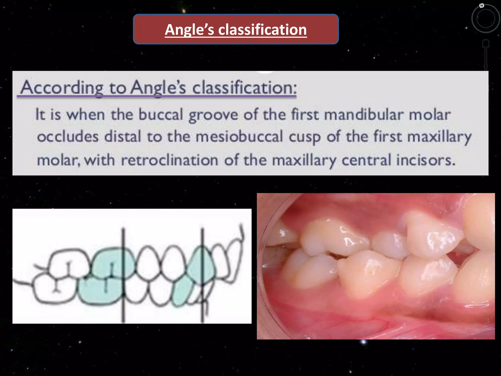 Class ii div 2 malocclusion | PPTX