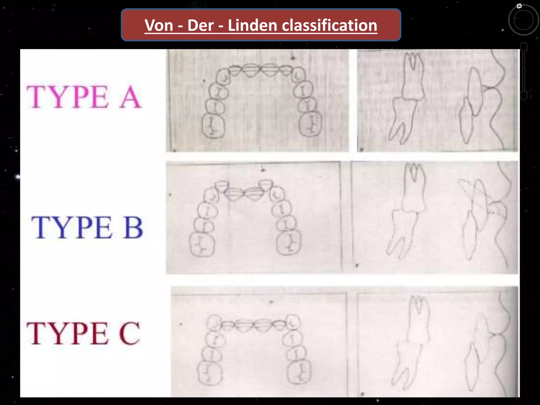 Class ii div 2 malocclusion | PPTX