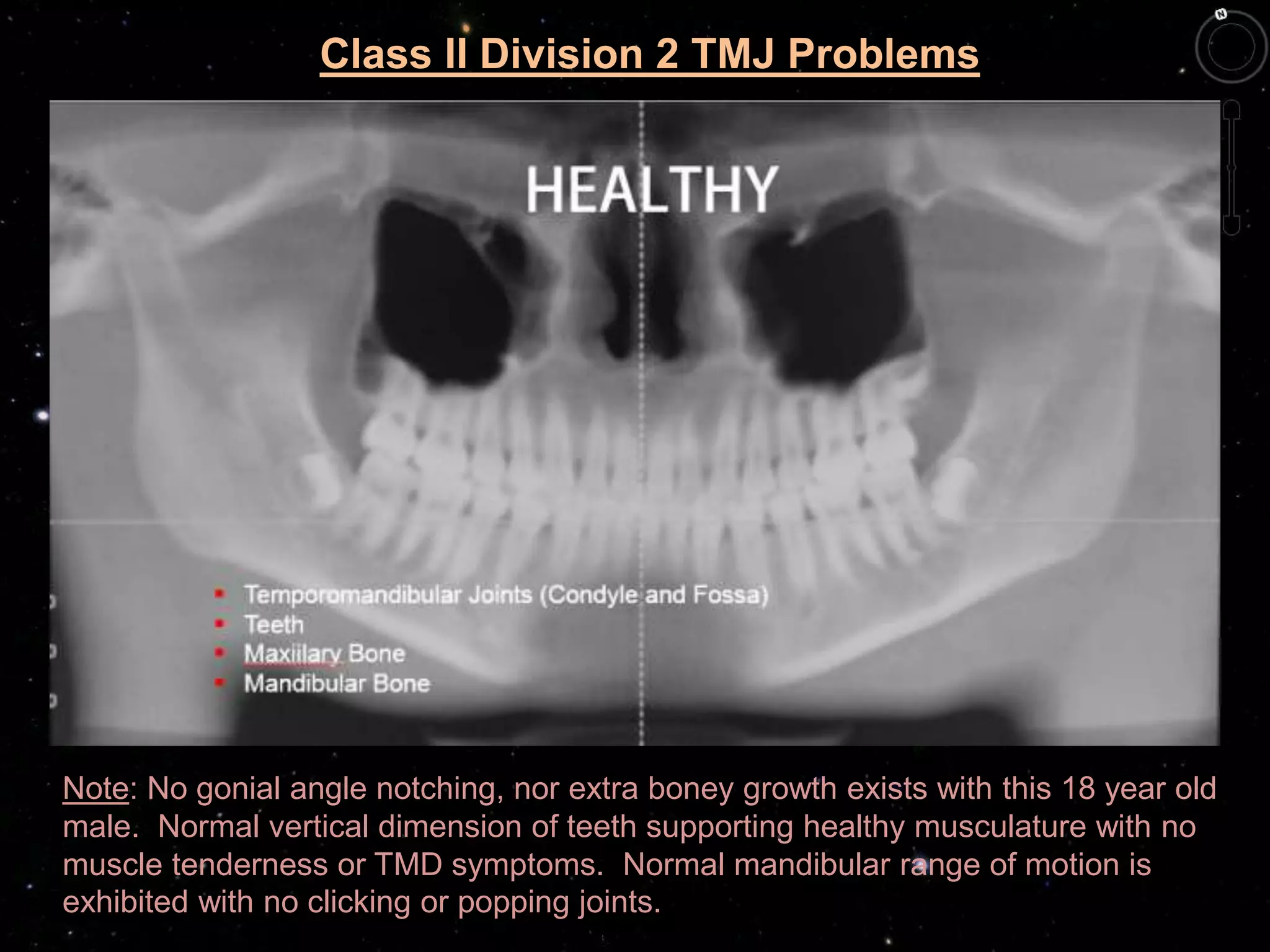 Class ii div 2 malocclusion | PPTX