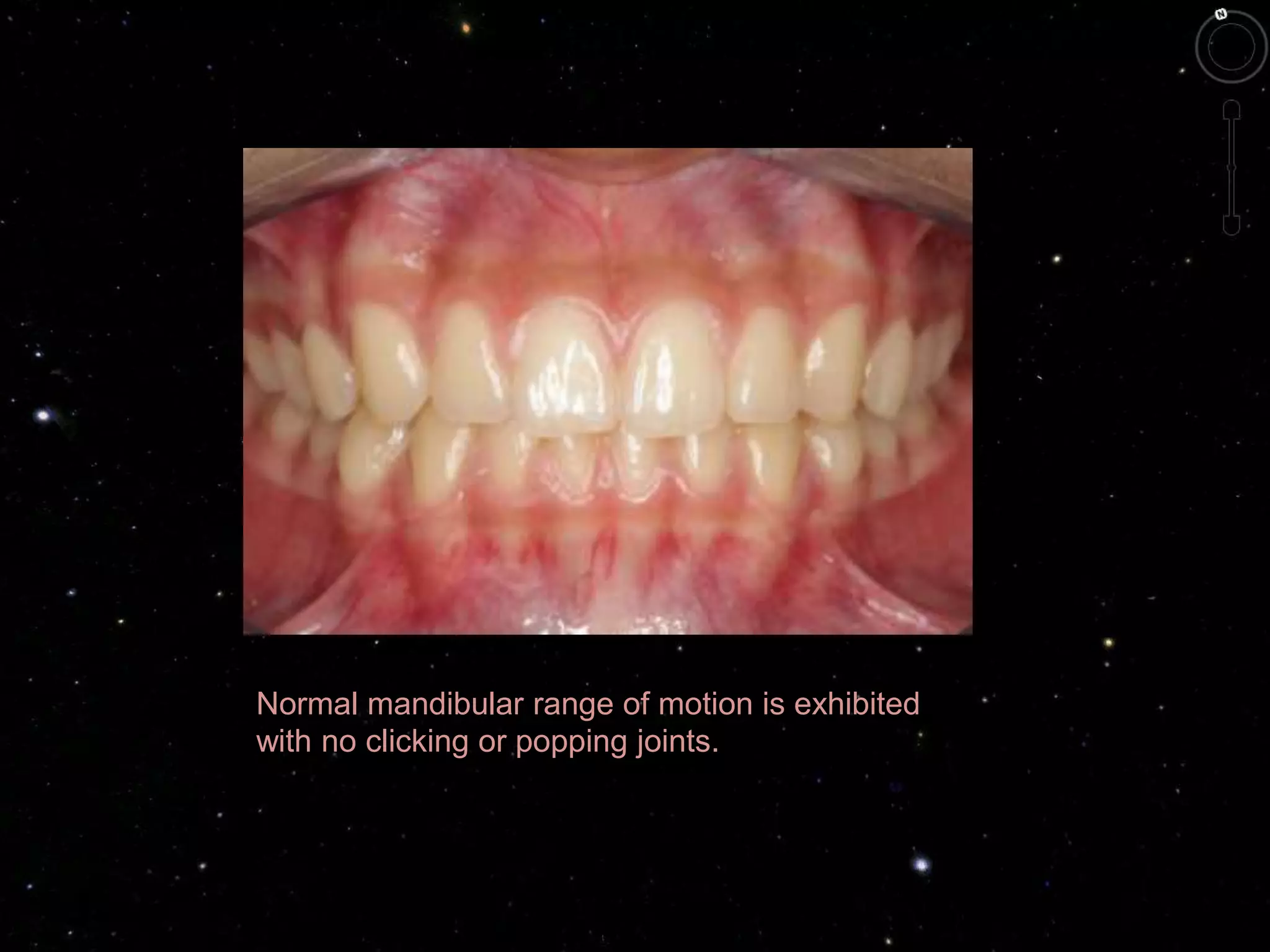 Class ii div 2 malocclusion | PPTX
