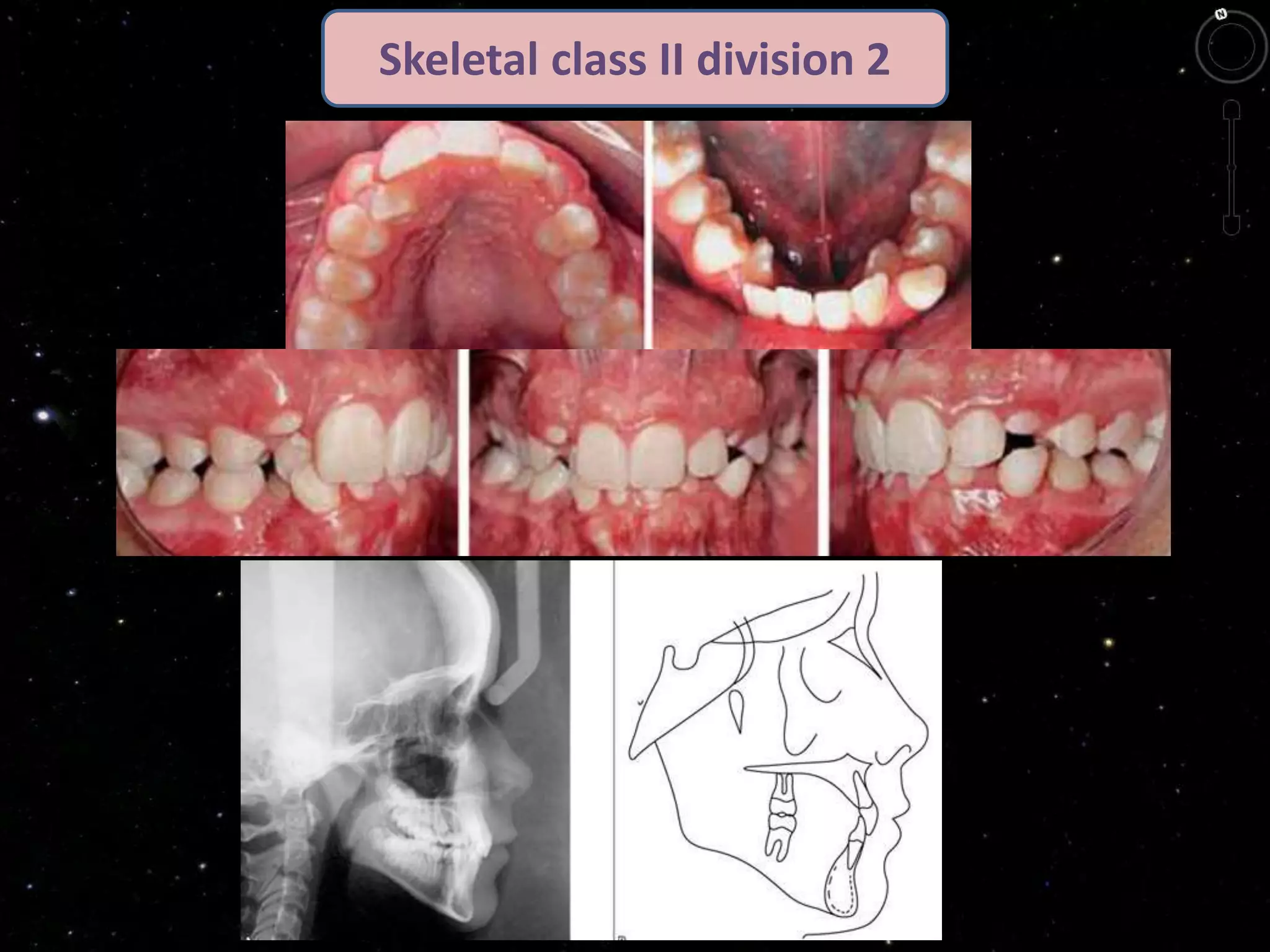 Class ii div 2 malocclusion | PPTX