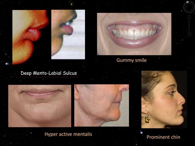 Class ii div 2 malocclusion | PPTX
