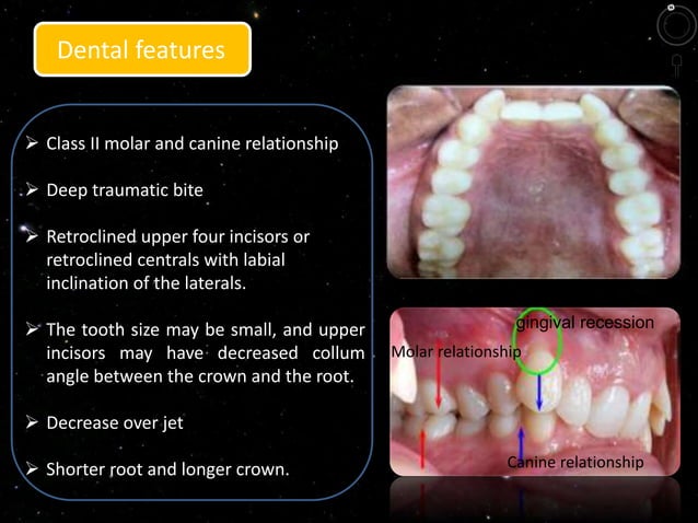 Class ii div 2 malocclusion | PPTX