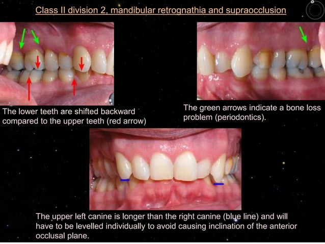 Class ii div 2 malocclusion | PPTX