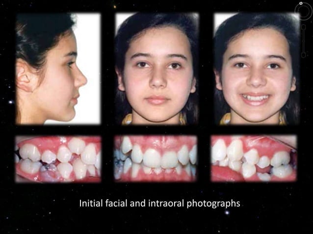 Class ii div 2 malocclusion | PPTX