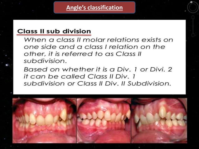 Class ii div 2 malocclusion | PPTX