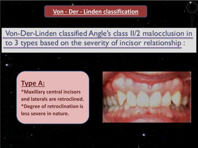 Class ii div 2 malocclusion | PPTX