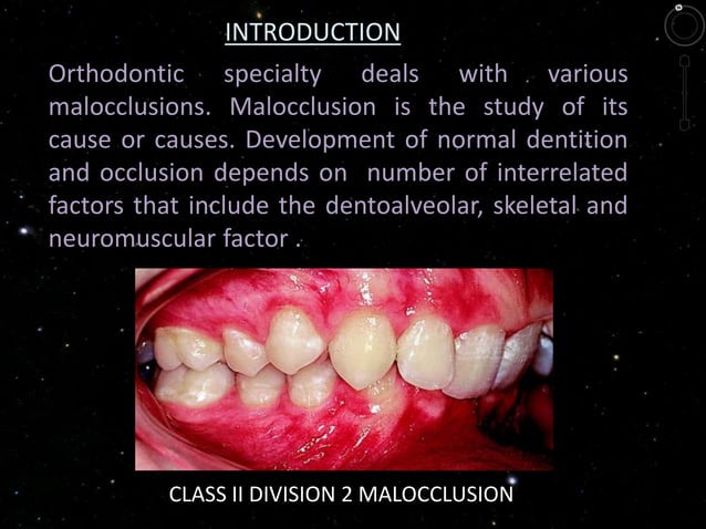 Class ii div 2 malocclusion | PPTX