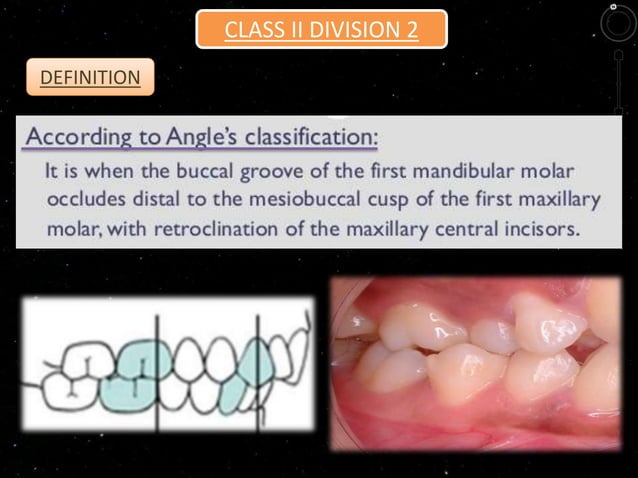 Class ii div 2 malocclusion | PPT | Free Download
