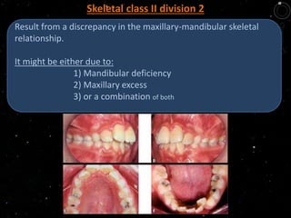 Class ii div 2 malocclusion | PPTX
