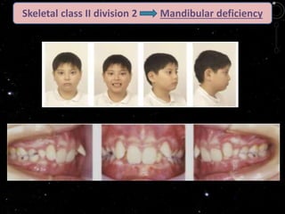 Class ii div 2 malocclusion | PPTX