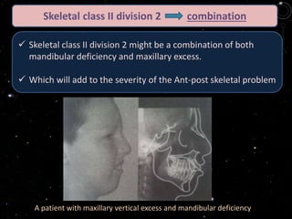 Class ii div 2 malocclusion | PPTX