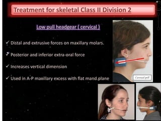 Class ii div 2 malocclusion | PPTX