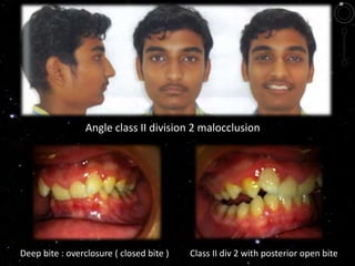 Class ii div 2 malocclusion | PPT