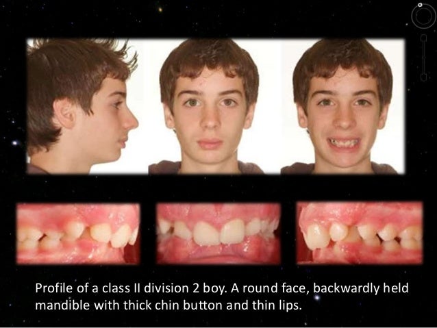 Class ii div 2 malocclusion