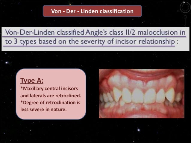 Class ii div 2 malocclusion