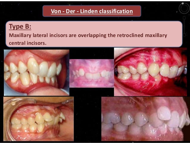 Class ii div 2 malocclusion