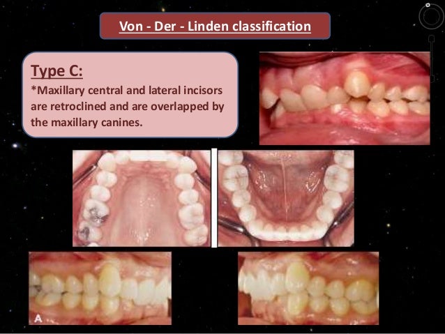 Class Ii Div 2 Malocclusion