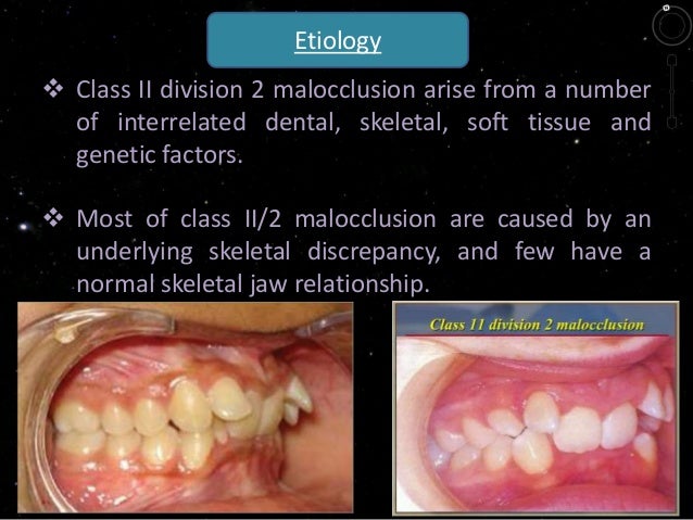 Class ii div 2 malocclusion