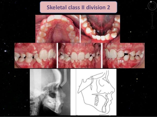 Class ii div 2 malocclusion