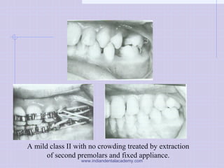Class 2, division 1 malocclusions | PPT