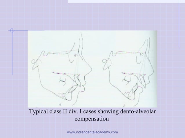 Class 2, division 1 malocclusions | PPT
