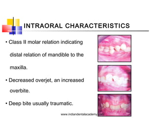 Class 2 division 2 malocclusion /certified fixed orthodontic courses by ...