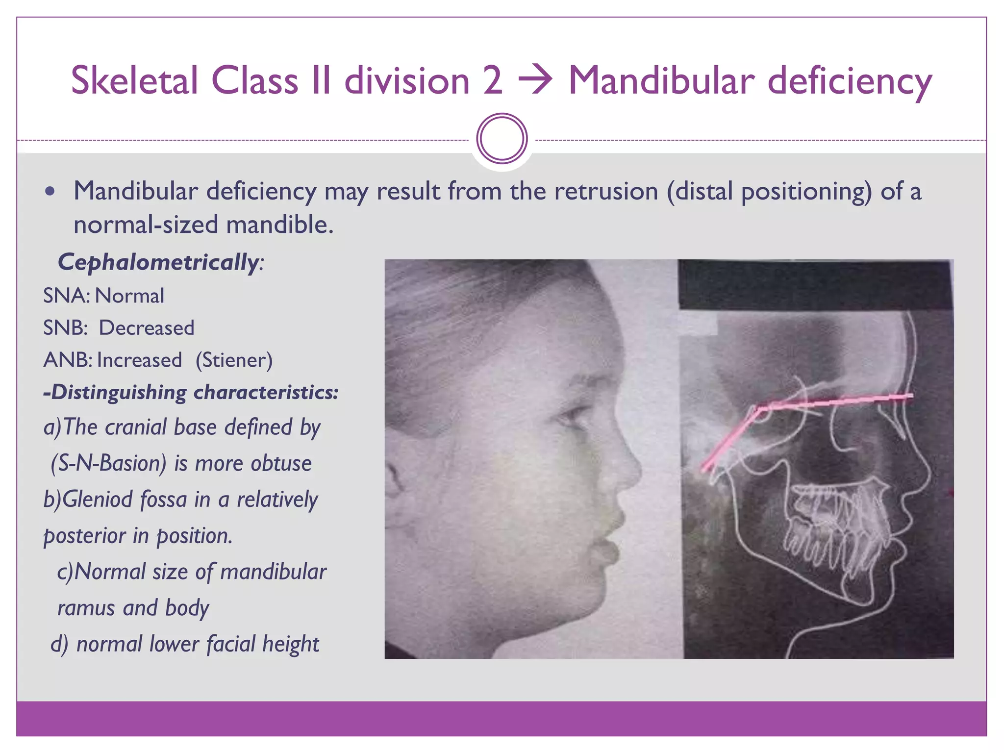 Class II division 2 malocclusion | PPTX